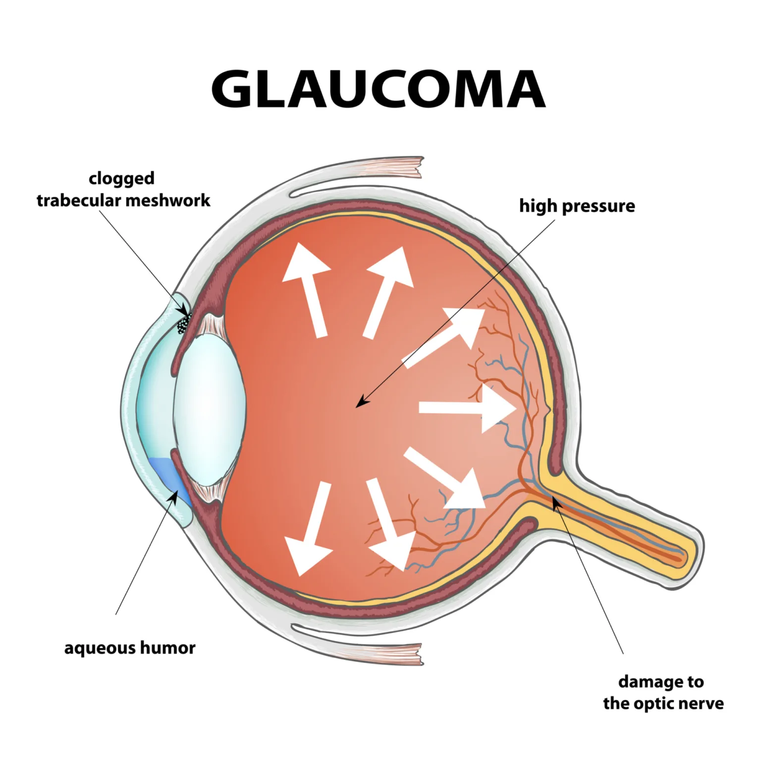 Glaucoma - Reiyukai Eiko Masunaga Eye Hospital